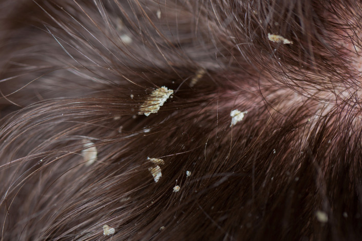 Dandruff vs. Head Lice - Lice Clinics of Texas